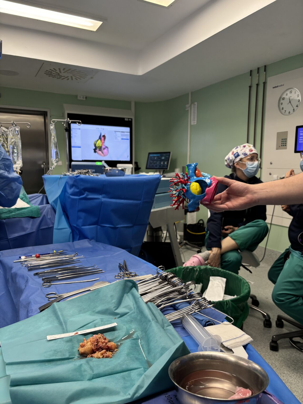 Rabdomioma cardiaco tratado quirúrgicamente con un modelo 3D - Cella ...